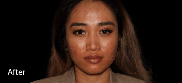 Botox for Acne Prone Skin - Medical Rejuvenation Centre