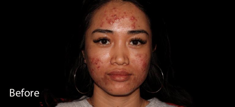 Botox for Acne Prone Skin - Medical Rejuvenation Centre